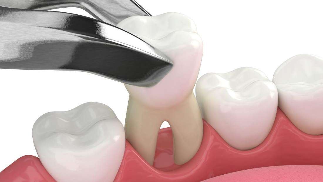 Losing A Blood Clot After A Tooth Extraction Tooth Extraction